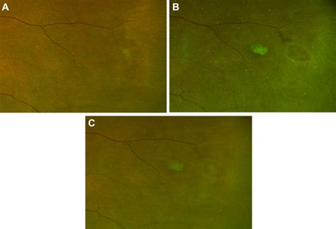 The Evolution Of A Vitreoretinal Tuft To An Operculated Hole