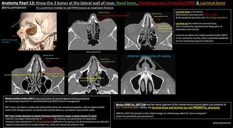 Human Nose Bone Anatomy