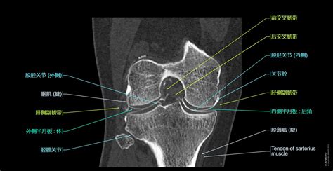 膝 Ct关节造影 正常解剖 E Anatomy