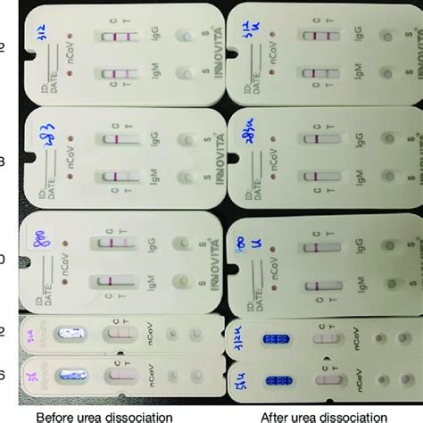 Sars Cov 2 Antibody Detected With Ics Assay Before And After Urea