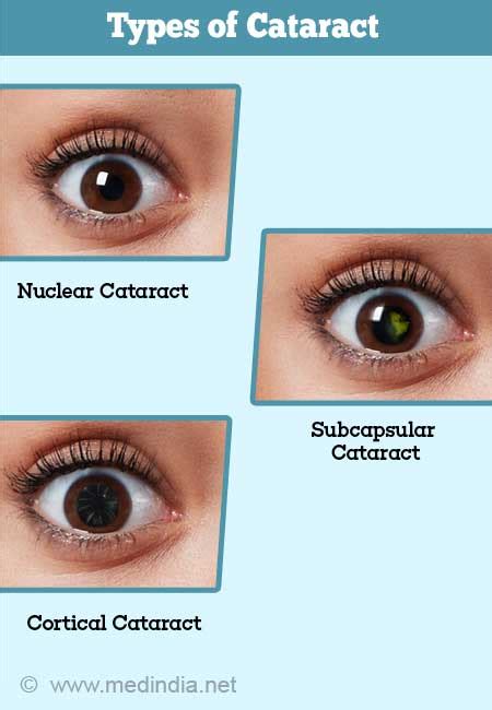 Cataract Types Images
