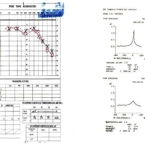 First Audiometry Test Results Right Hearing Within Normal Limits At