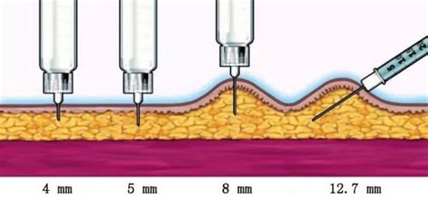 The Complete Guide To Proper Insulin Pen Needle Use Mastering Diabetes