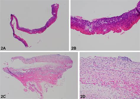 Recurrent Hemorrhagic Bullae Of The Oral Mucosa Jaad Case Reports