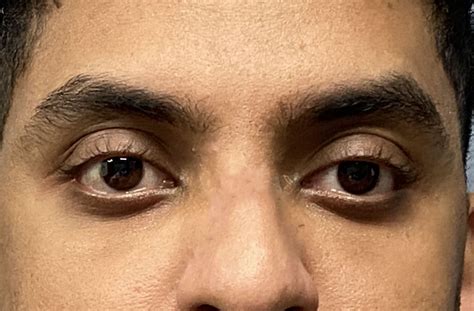 Plastic Surgery Case Study Custom Iom Infraorbital Malar Implants