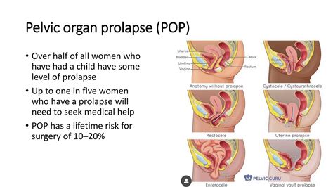 Pelvic Organ Prolapsepptx