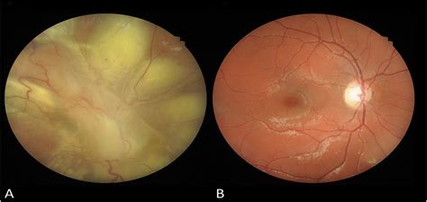 Cat Scratch Disease Imitating A Toxocara Granuloma Of The Op Retinal Cases And Brief Reports