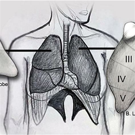 Left Upper Lobe Apical Bleb Thoracoscopic View Download Scientific Diagram