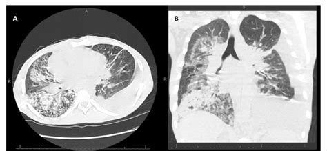 Chest Ct At Admission A Transverse Cross Sectional And B Coronal