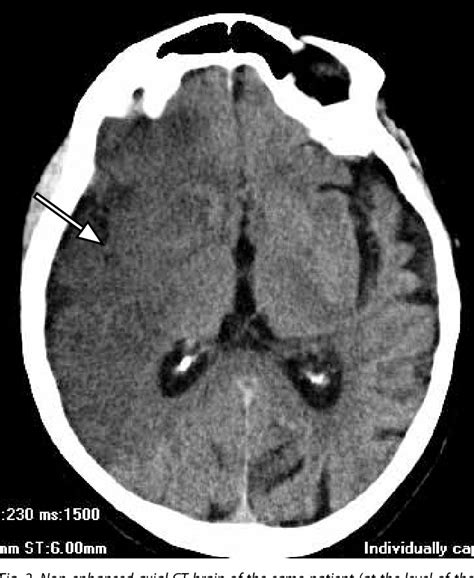 Figure 2 From The Hyperdense Mca Sign And The Mca Dot Sign Semantic