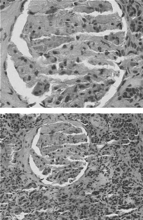 A Glomerulus Showing Mesangiolysis With Extravasated Rbcs And Download Scientific Diagram