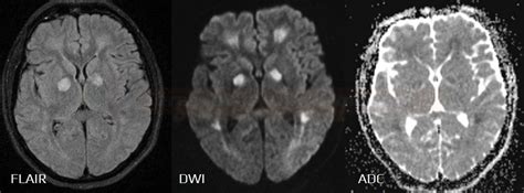 Mr Dwi In The Acute Stroke Diagnosis Stroke Manual
