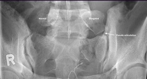 Bertolotti Syndrome Dr Mahmood Ahmad