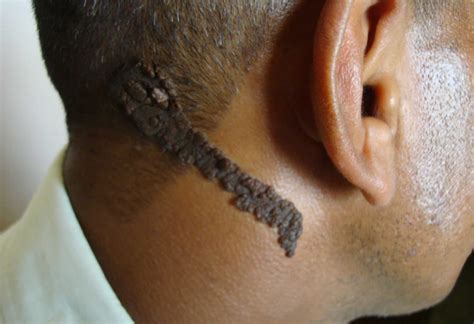 Nevus Definition Types Diagnosis And Nevus Treatment