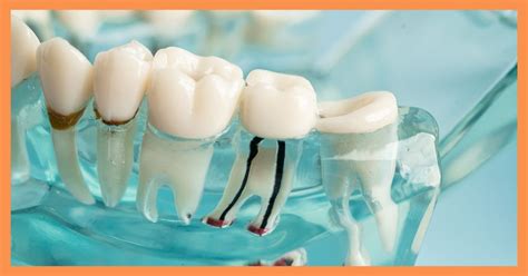 The Benefits Of A Root Canal Why Its Better Than Tooth Extraction