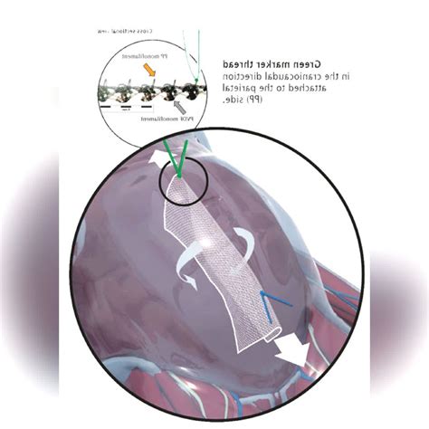 Durable Abdominal Hernia Prosthesis Sale Or Rent Near Me Goldstar