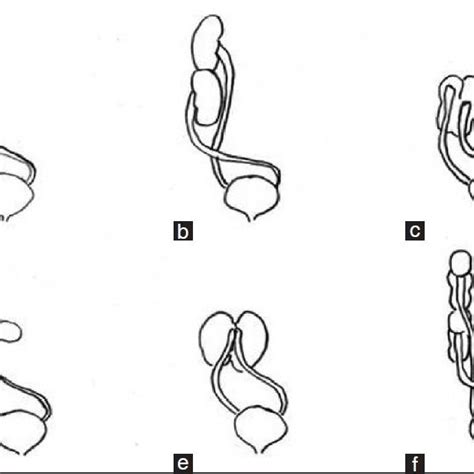 Diagrammatic Representation Of Classification Of Crossed Fused Renal