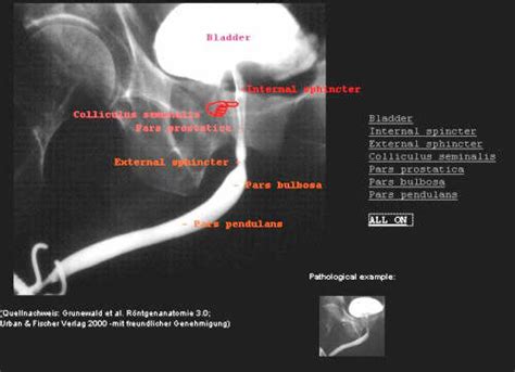 Micturating Cystourethrogram Mcug Society Of Radiological