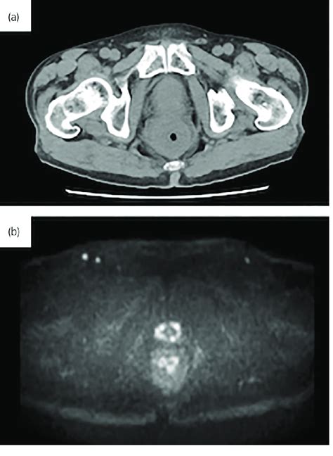 A Ct And B Diffusion Weighted Imaging Magnetic Resonance Imaging