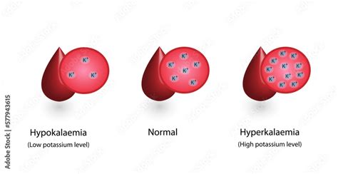 Vetor De Hyperkalaemia High Plasma Potassium Level And Hypokalaemia Low Plasma Potassium Level