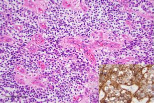 Recent Advances In The Pathology Of Pediatric Brain And Spinal Tumors