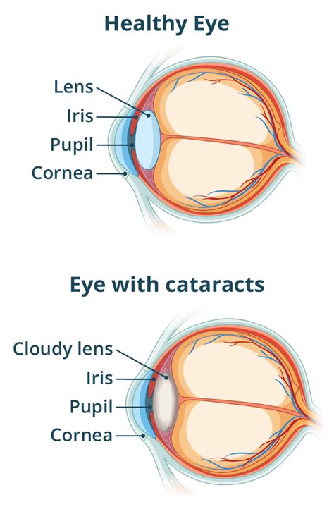 Cataract Definition The Best Cataract Surgery Lenses Options Doctor
