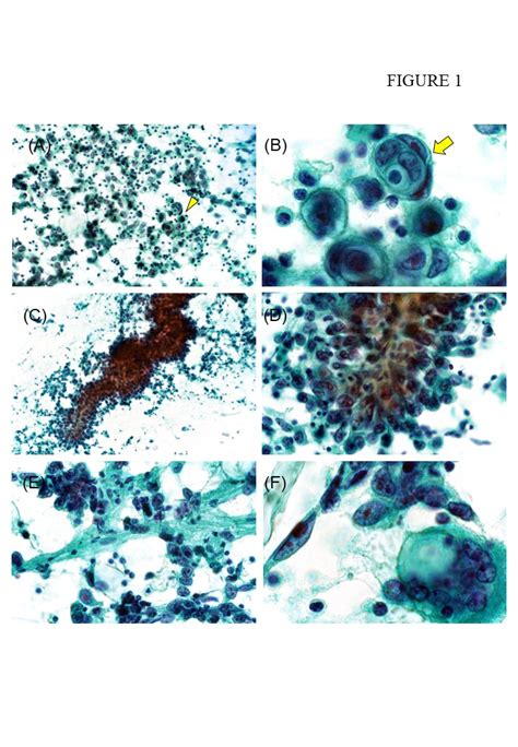 Diagnostic Dilemma Differentiating Radiation Associated Breast