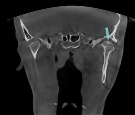 Condyle Deformity Rtmj