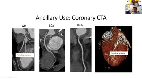 Role Of Cardiac Ct In Endocarditis Youtube