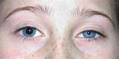 Unequal Pupils Eye Disorders Msd Manual Consumer Version
