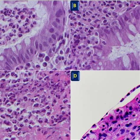 A Crypt Abscess Hematoxylin Eosin Dye Magnification X 40 B Download Scientific Diagram