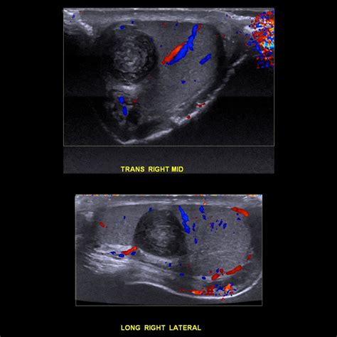 Pediatric Testicular Epidermoid Cyst Pediatric Radiology Reference