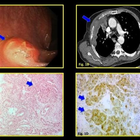 A Colonoscopy Found A Polyp Tumour Lesion Of The Transverse Colon Download Scientific Diagram