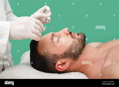 Acupuncturist Inserting Acupuncture Needles Into Patients Skin Head