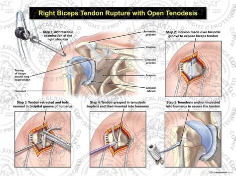 Why Do I Need A Biceps Tenodesis For A Labrum Tear
