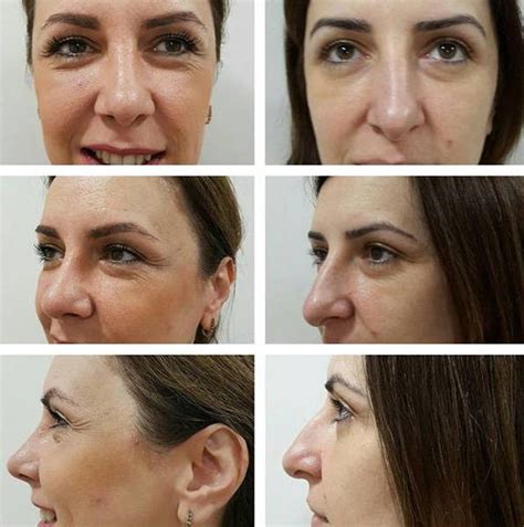 Deviated Septum Post Surgery 3 Rhinoplasty Cost Pics Reviews Qanda