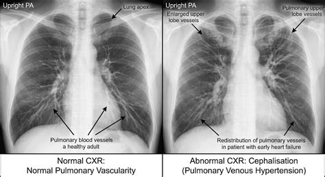 Findings Lungs Heart Cephalisation Redistribution Chfantler Sign