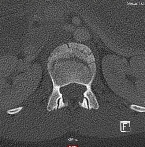 Dr Med Mohsen Ghiassi On Linkedin Minimally Spine Aospine