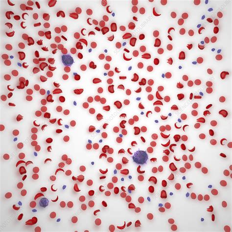 Sickle Cell Blood Smear