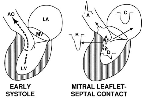 Hypertrophic Cardiomyopathy Circulation