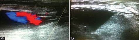 Ultrasound Guided Thrombin Injection For The Treatment Of Ia West
