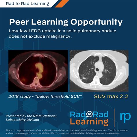 Rad To Rad Learning Solid Pulmonary Nodules On Fdg Petct