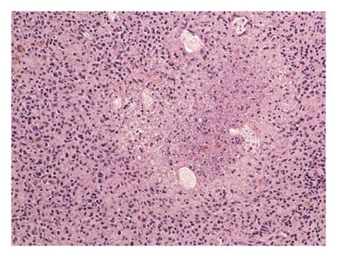 Lymph Node With Necrotizing Granuloma Comprised Of Necrotic Center
