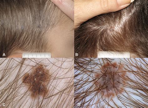 Diagnosis And Management Of Melanoma Of The Scalp Ccid