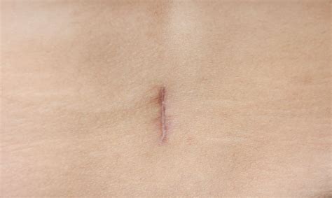 Preventing And Managing Keloid Formation In Surgical Patients Ark Surgical Practice