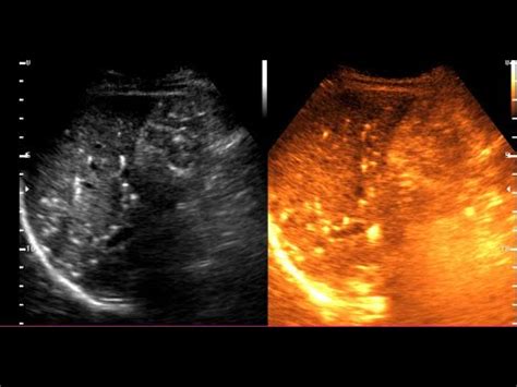 Pneumobilia On Ultrasound Key Signs And Findings How To Identify