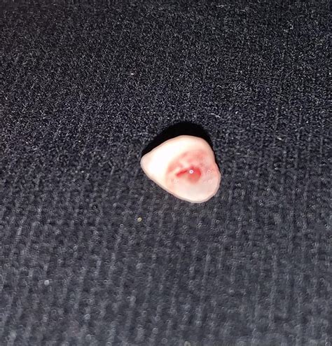 Have One Of My Adult Teeth Fallen Out Rteeth