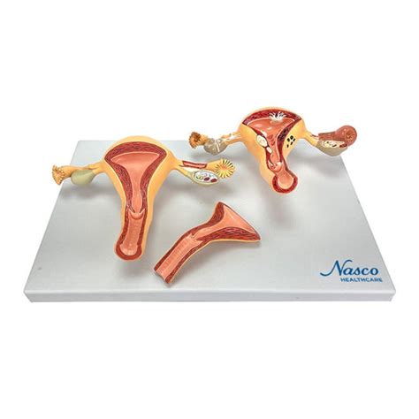 Healthy And Pathological Uterus Model Nasco Healthcare