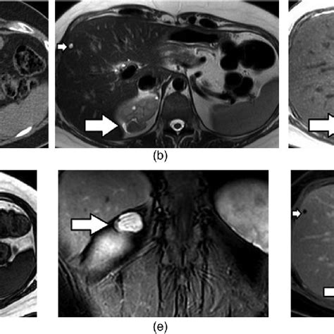 A Axial T2w Shows A Well Defined Left Upper Pole Renal Mass Arrow