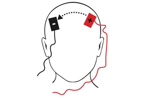 Sooma Tdcs Device Research Use Caputron